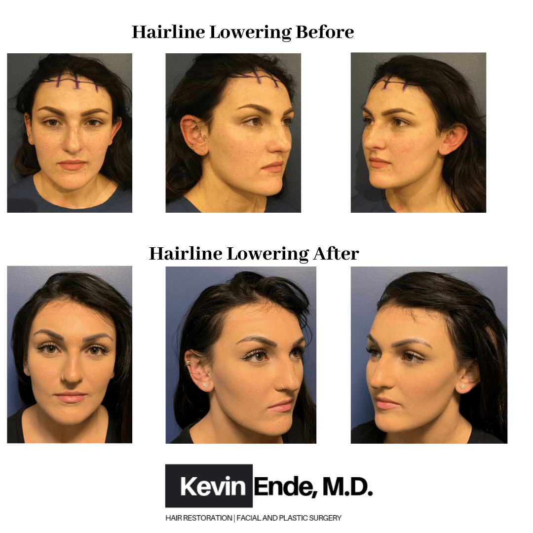 Facelift | Englewood, NJ | Dr. Kevin Ende, M.D.
