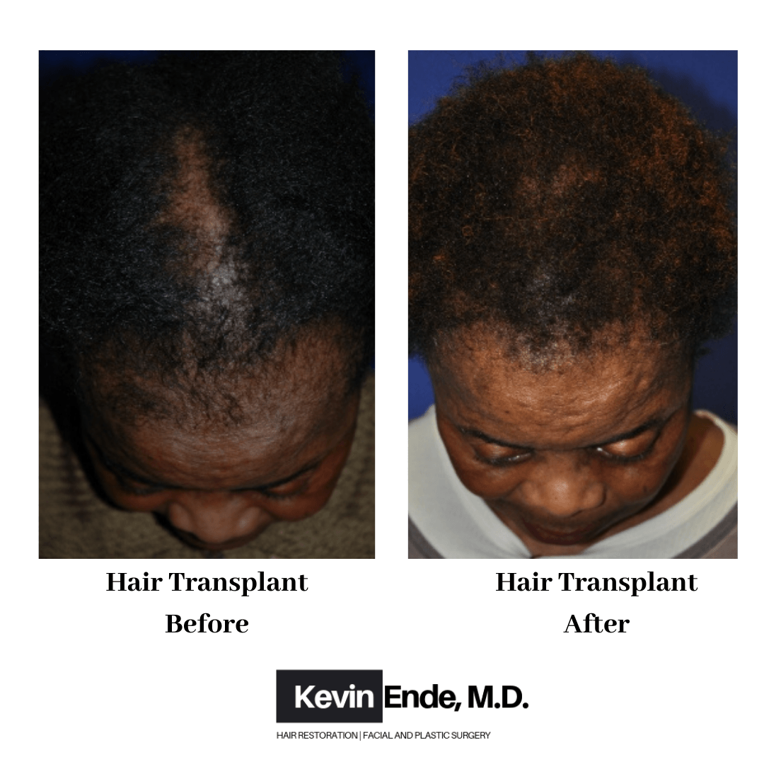 Facelift | Englewood, NJ | Dr. Kevin Ende, M.D.