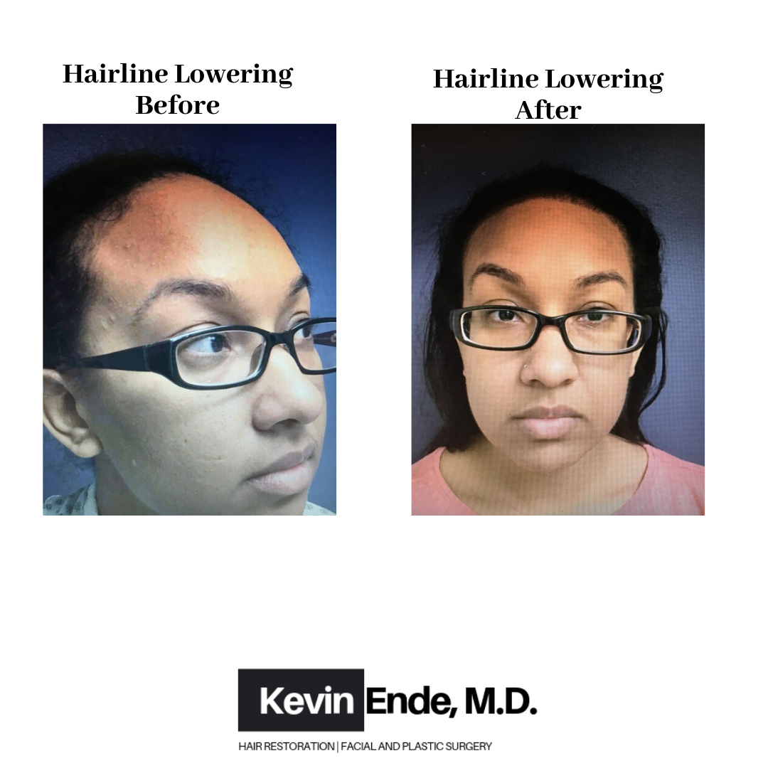 Facelift | Englewood, NJ | Dr. Kevin Ende, M.D.