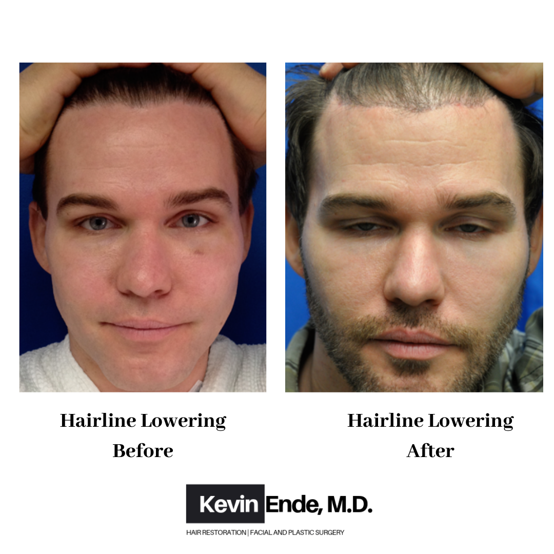 Facelift | Englewood, NJ | Dr. Kevin Ende, M.D.