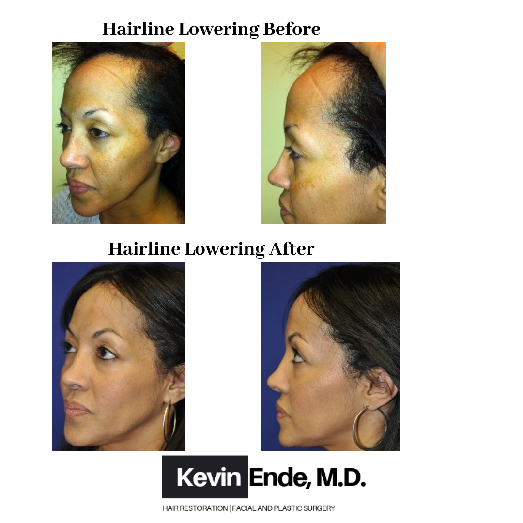 Facelift | Englewood, NJ | Dr. Kevin Ende, M.D.