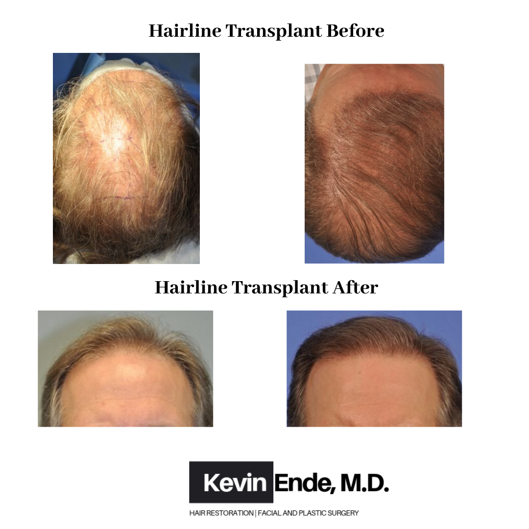 Facelift | Englewood, NJ | Dr. Kevin Ende, M.D.