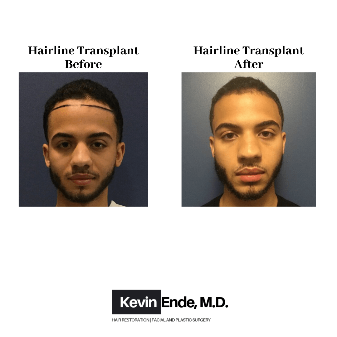 Facelift | Englewood, NJ | Dr. Kevin Ende, M.D.