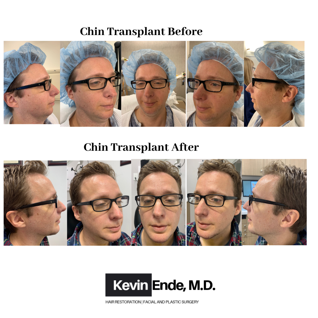 Facelift | Englewood, NJ | Dr. Kevin Ende, M.D.
