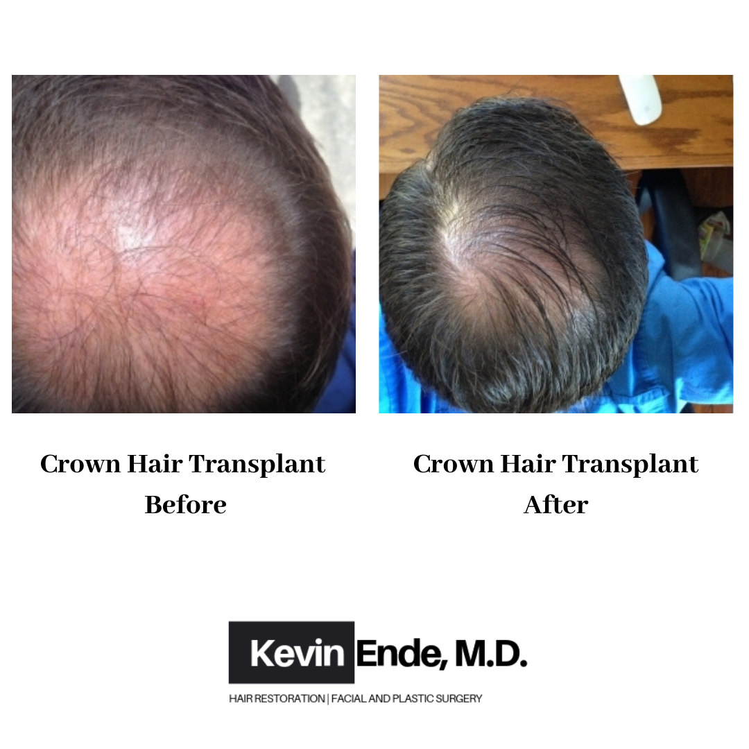 Facelift | Englewood, NJ | Dr. Kevin Ende, M.D.