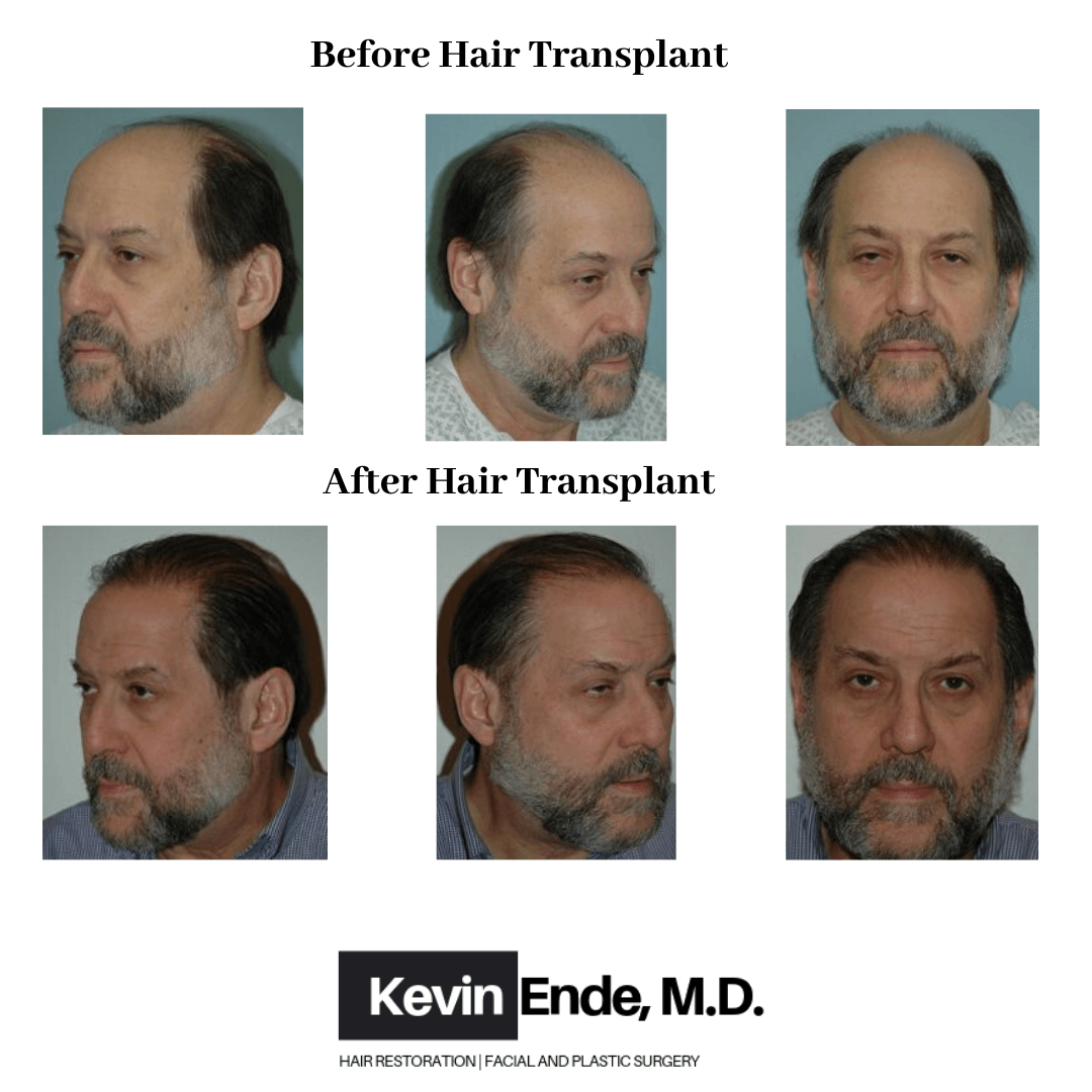 Facelift | Englewood, NJ | Dr. Kevin Ende, M.D.