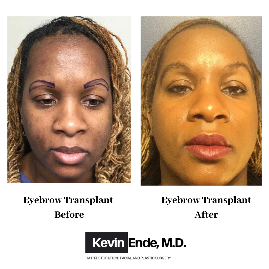 Facelift | Englewood, NJ | Dr. Kevin Ende, M.D.