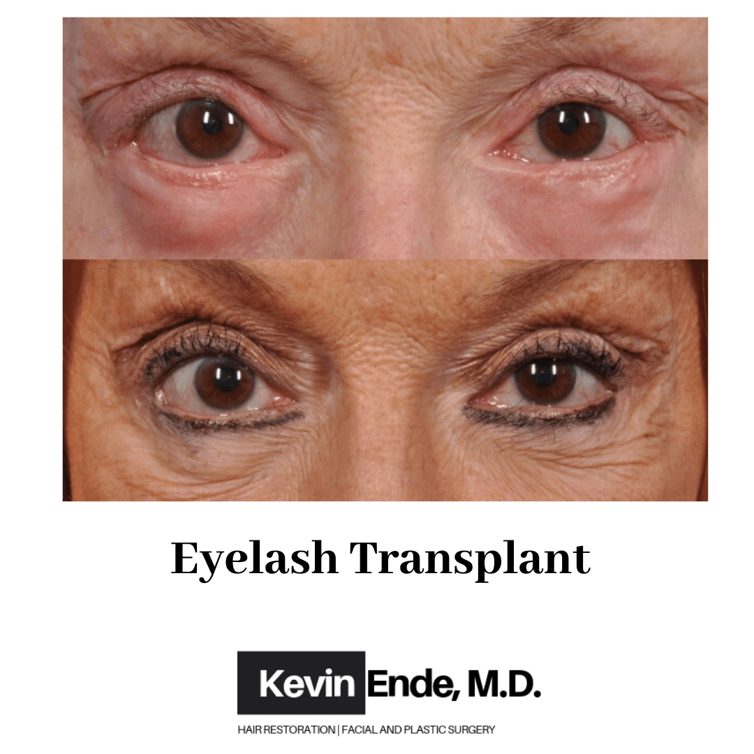 Facelift | Englewood, NJ | Dr. Kevin Ende, M.D.