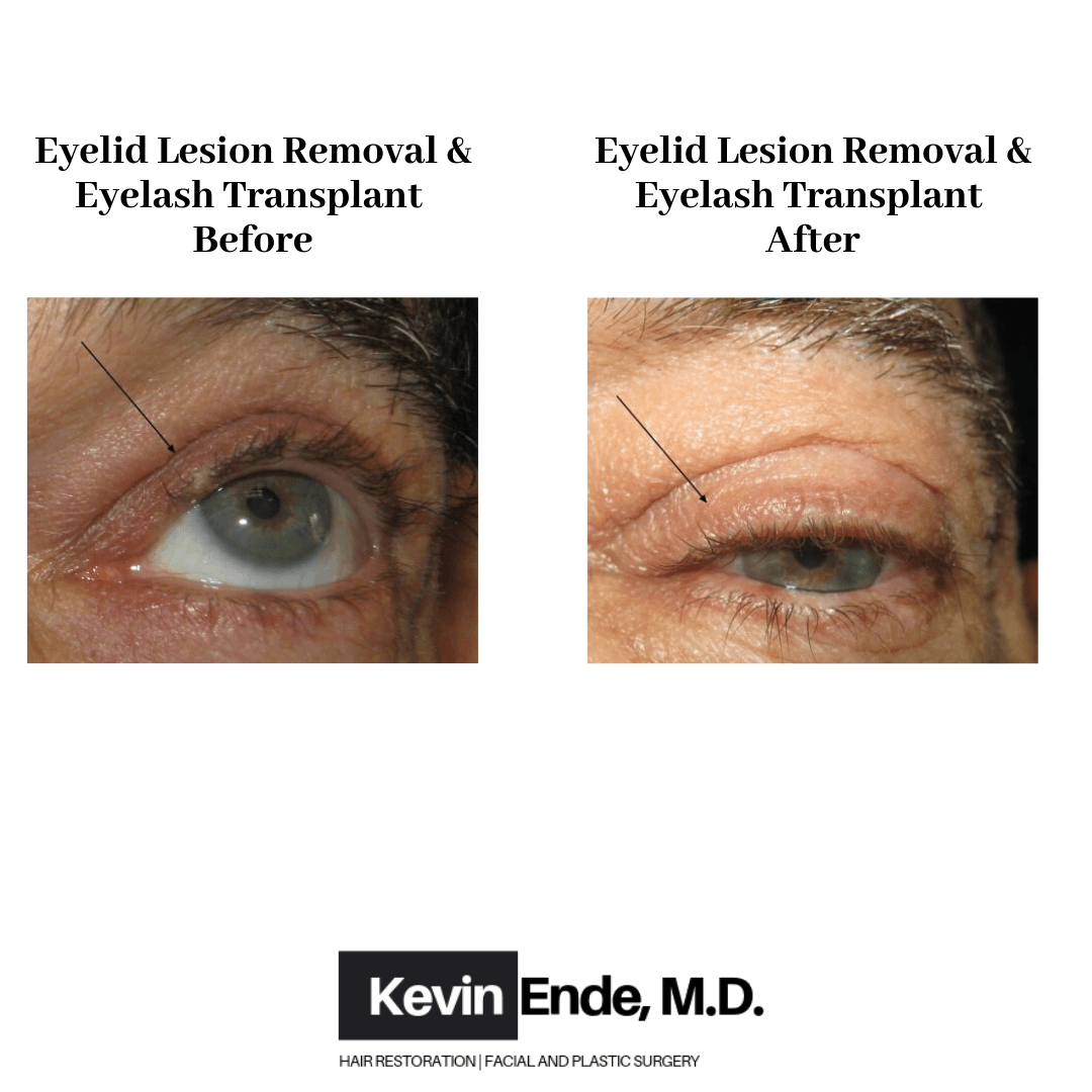 Facelift | Englewood, NJ | Dr. Kevin Ende, M.D.