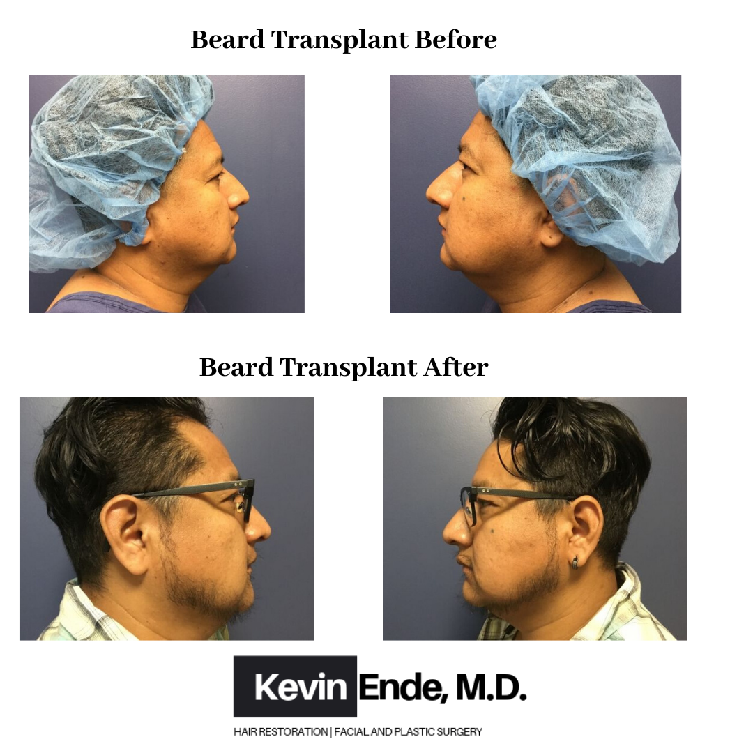 Facelift | Englewood, NJ | Dr. Kevin Ende, M.D.
