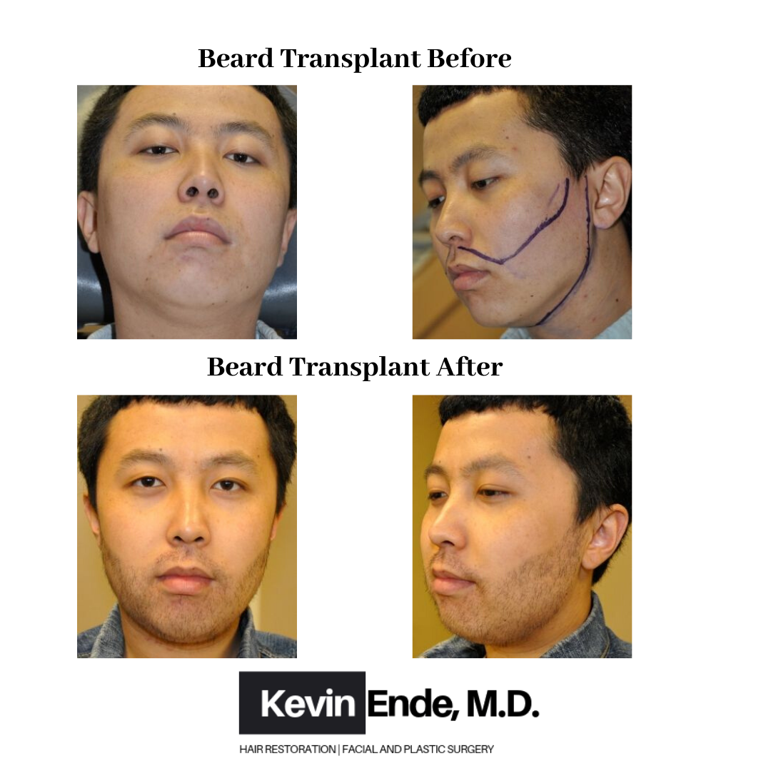 Facelift | Englewood, NJ | Dr. Kevin Ende, M.D.