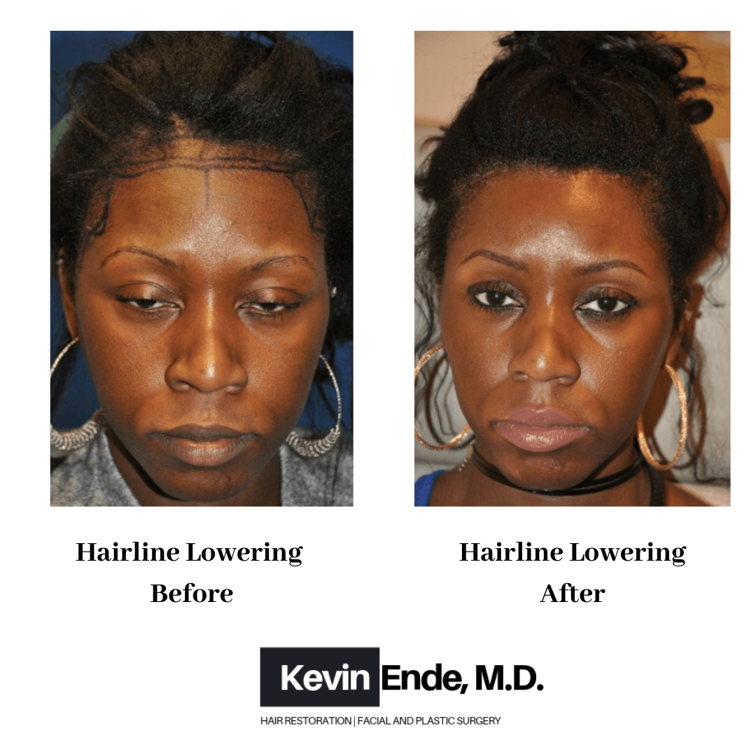 Facelift | Englewood, NJ | Dr. Kevin Ende, M.D.