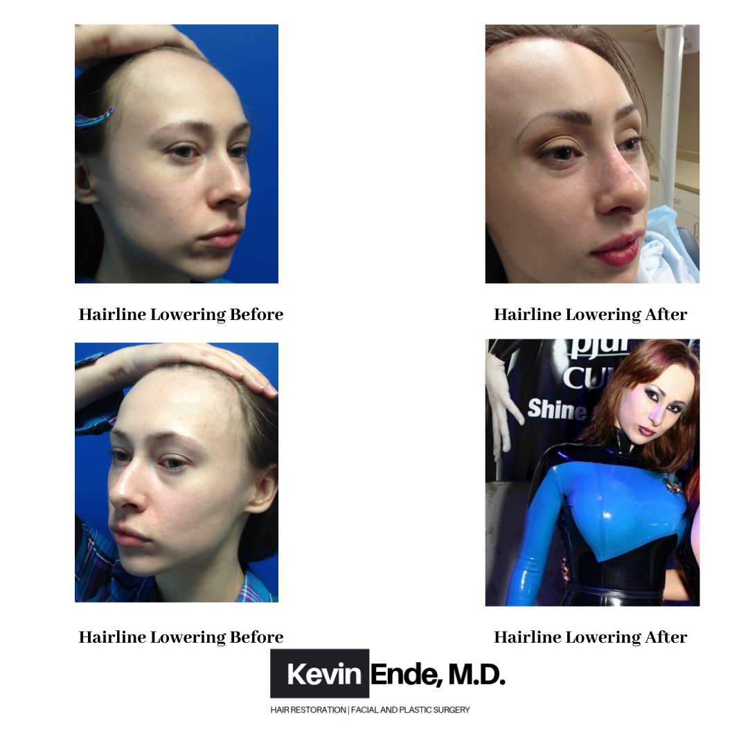 Facelift | Englewood, NJ | Dr. Kevin Ende, M.D.