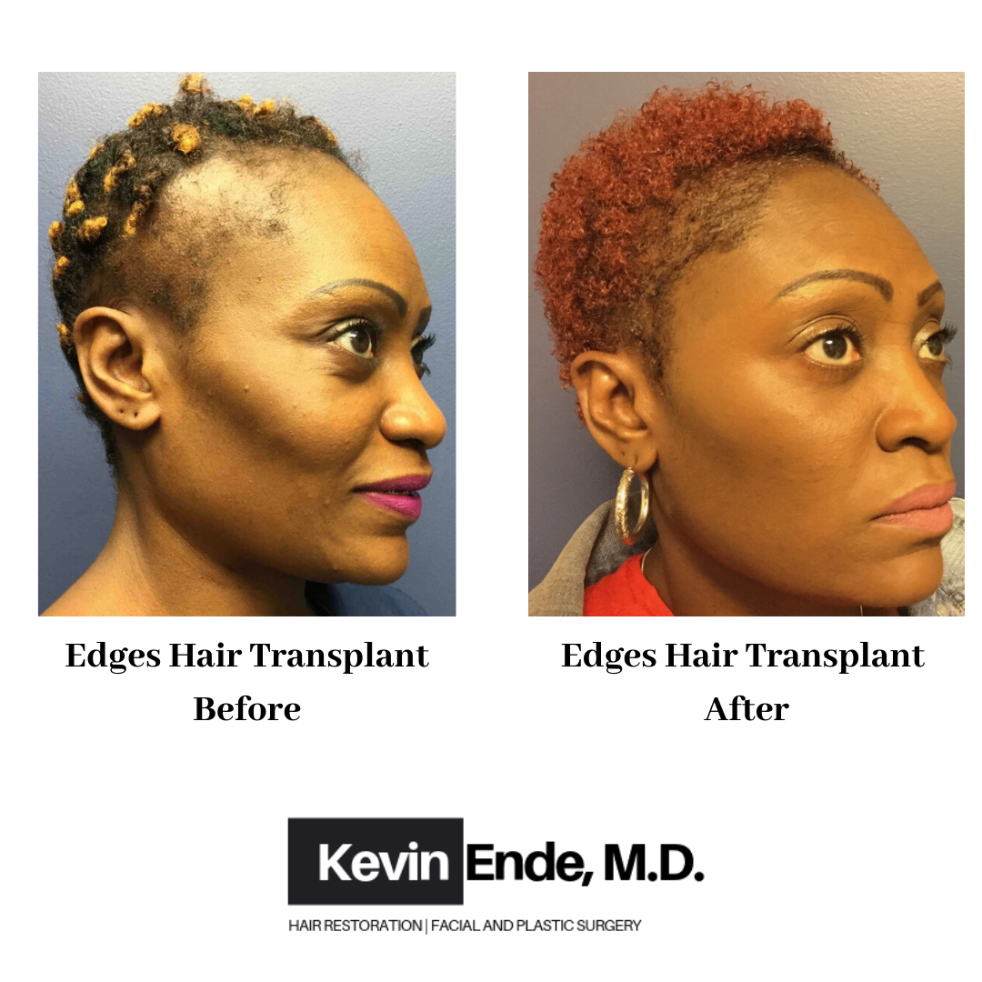 Facelift | Englewood, NJ | Dr. Kevin Ende, M.D.