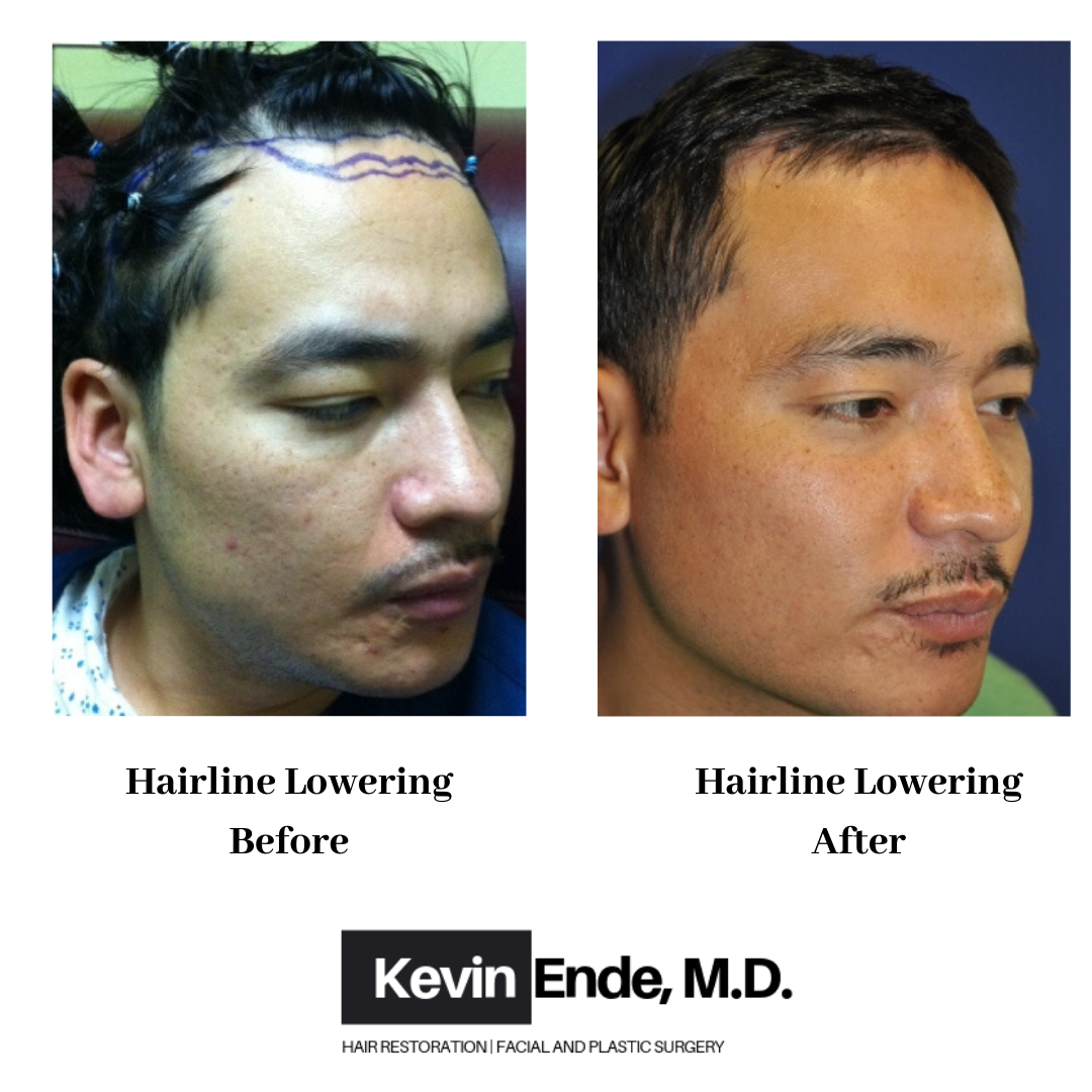 Hairline Lowering