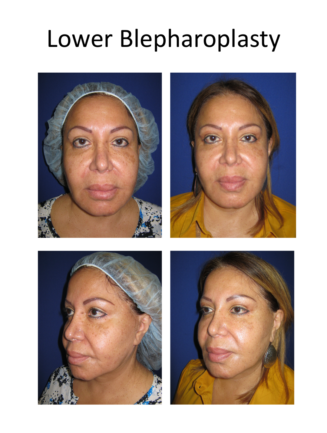 Facelift | Englewood, NJ | Dr. Kevin Ende, M.D.