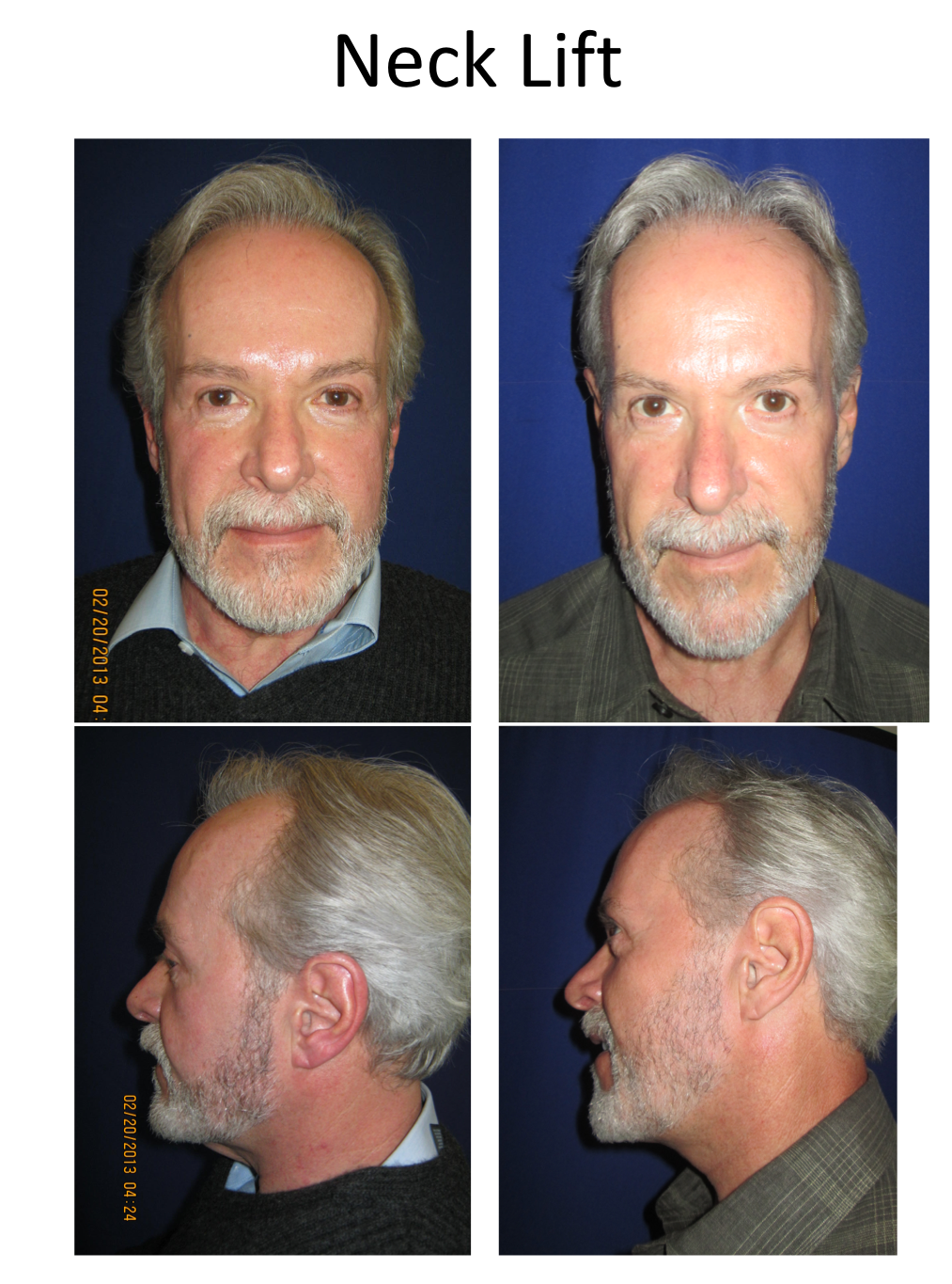 Facelift | Englewood, NJ | Dr. Kevin Ende, M.D.