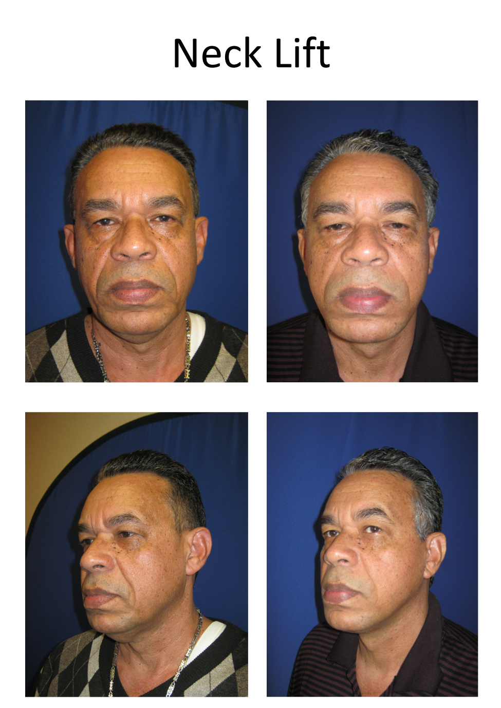 Facelift | Englewood, NJ | Dr. Kevin Ende, M.D.