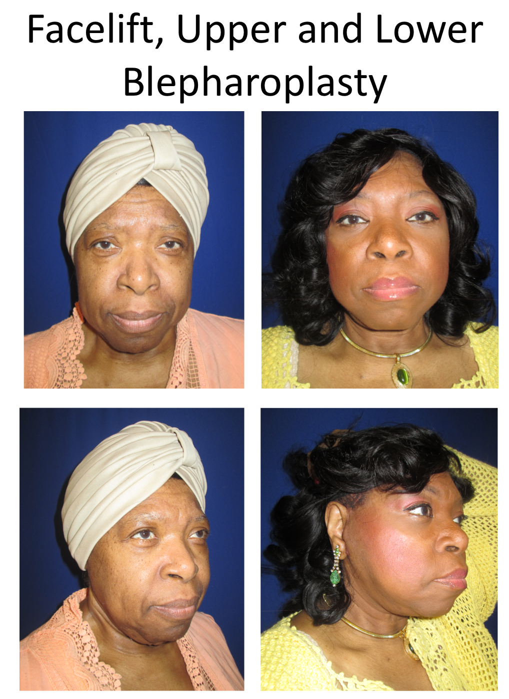 Facelift | Englewood, NJ | Dr. Kevin Ende, M.D.