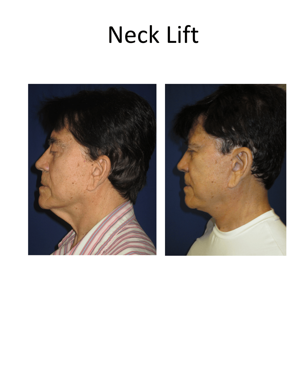 Facelift | Englewood, NJ | Dr. Kevin Ende, M.D.