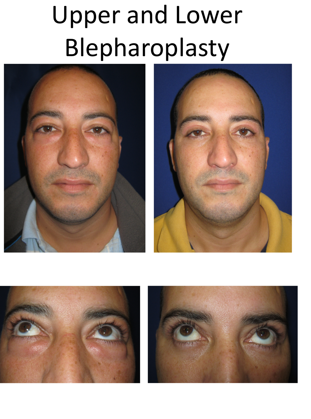 Facelift | Englewood, NJ | Dr. Kevin Ende, M.D.