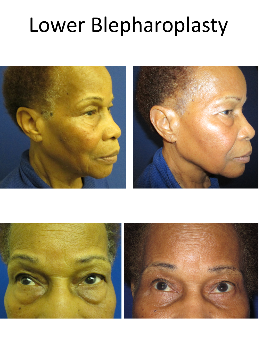 Facelift | Englewood, NJ | Dr. Kevin Ende, M.D.