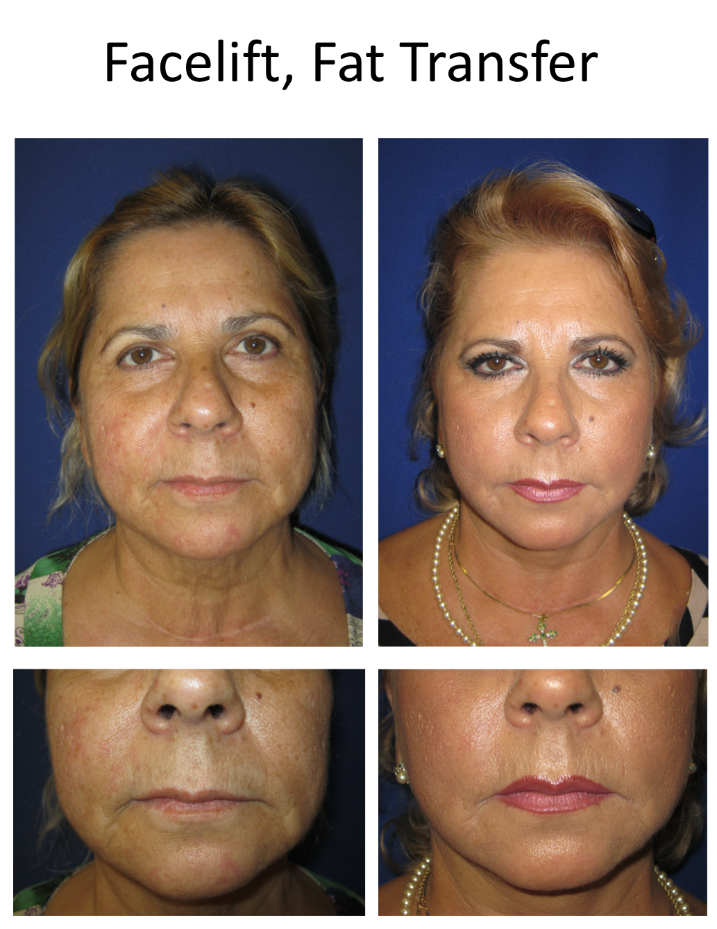 Facelift | Englewood, NJ | Dr. Kevin Ende, M.D.