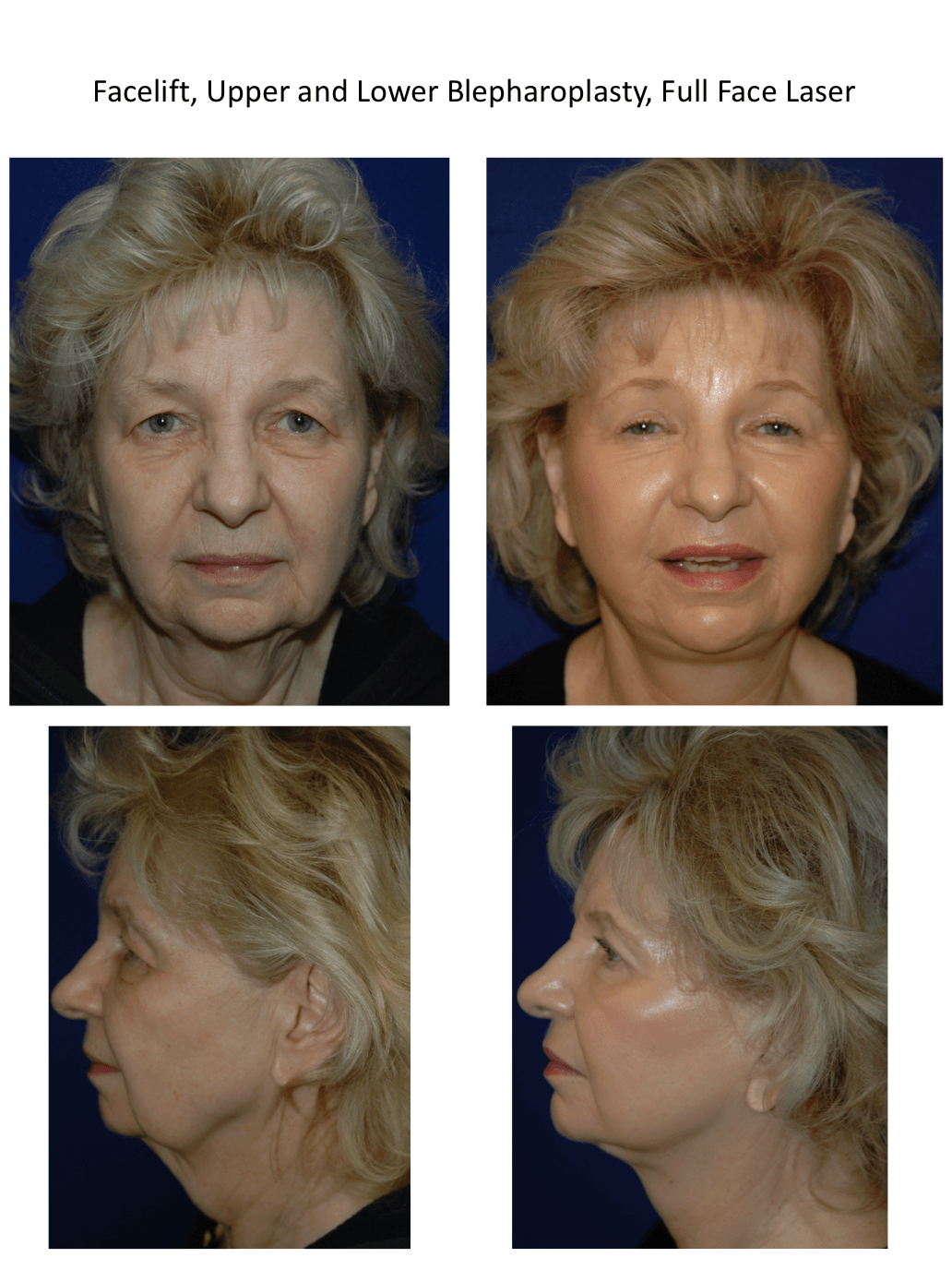Facelift | Englewood, NJ | Dr. Kevin Ende, M.D.