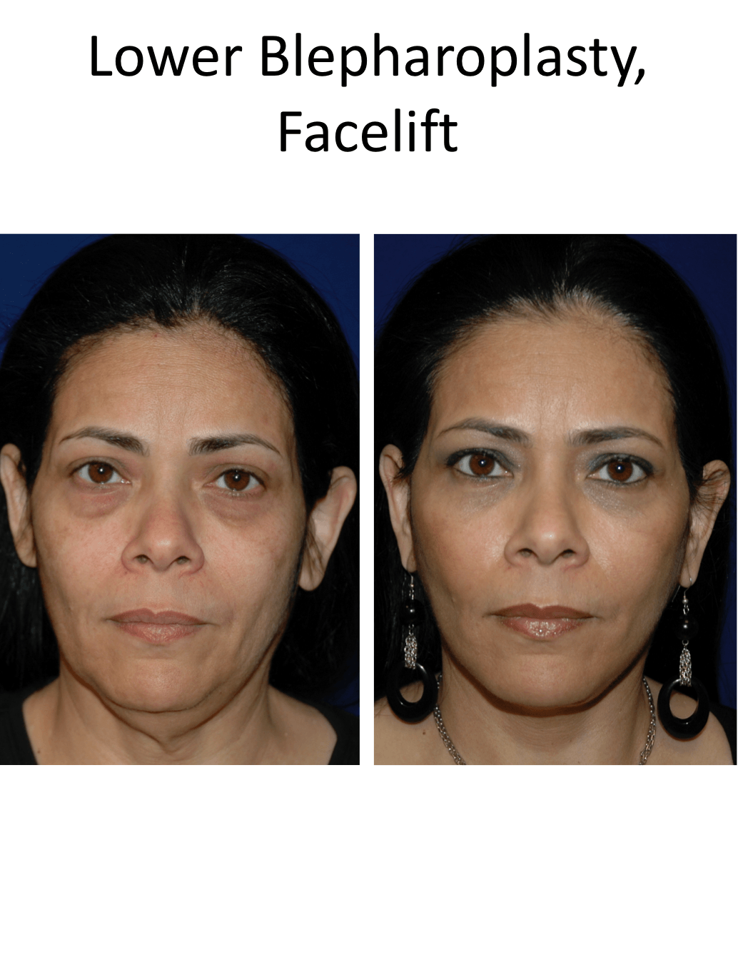 Facelift | Englewood, NJ | Dr. Kevin Ende, M.D.