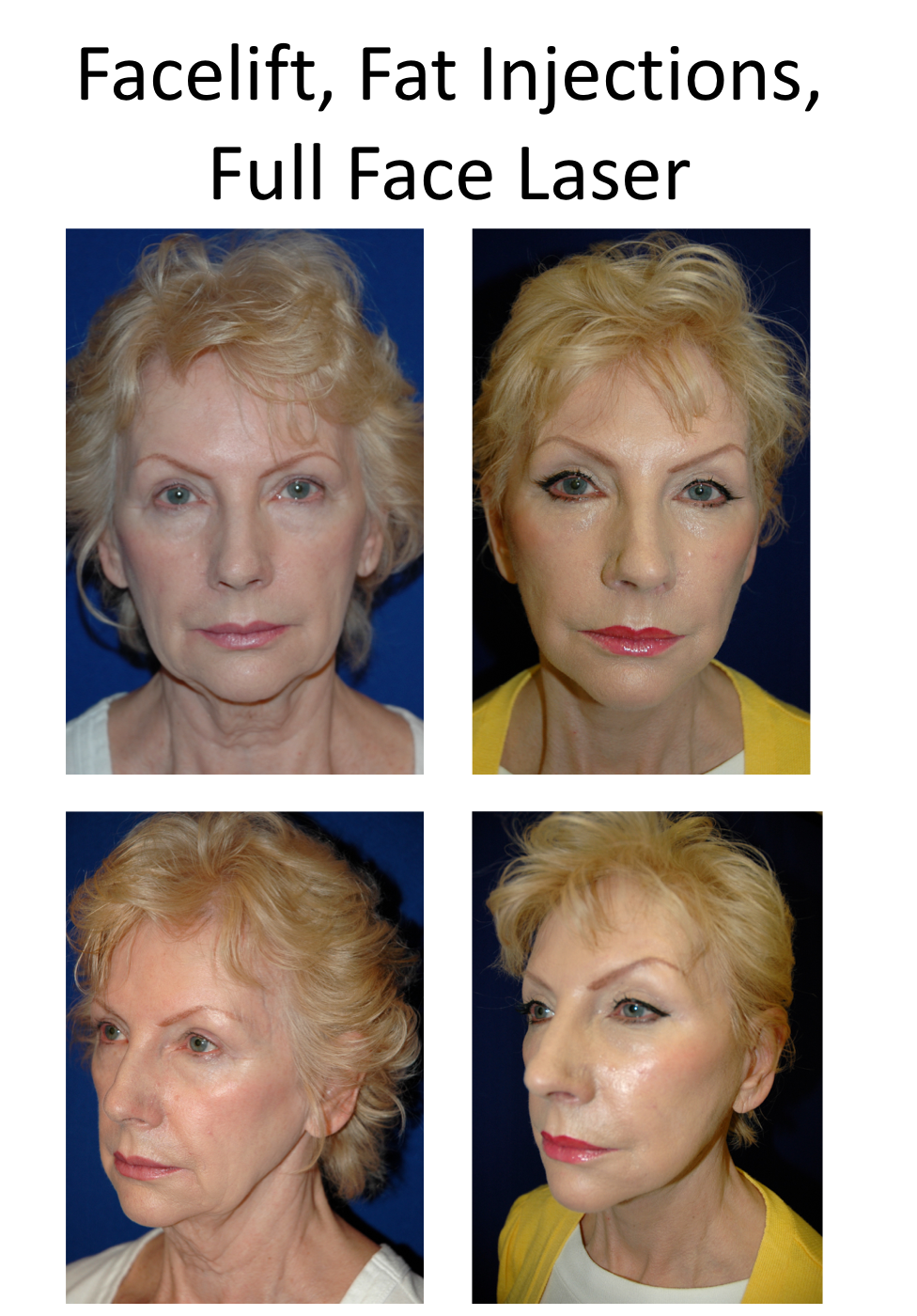 Facelift | Englewood, NJ | Dr. Kevin Ende, M.D.