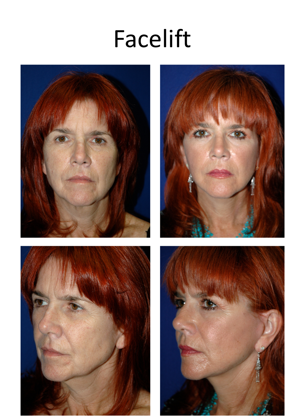 Facelift | Englewood, NJ | Dr. Kevin Ende, M.D.