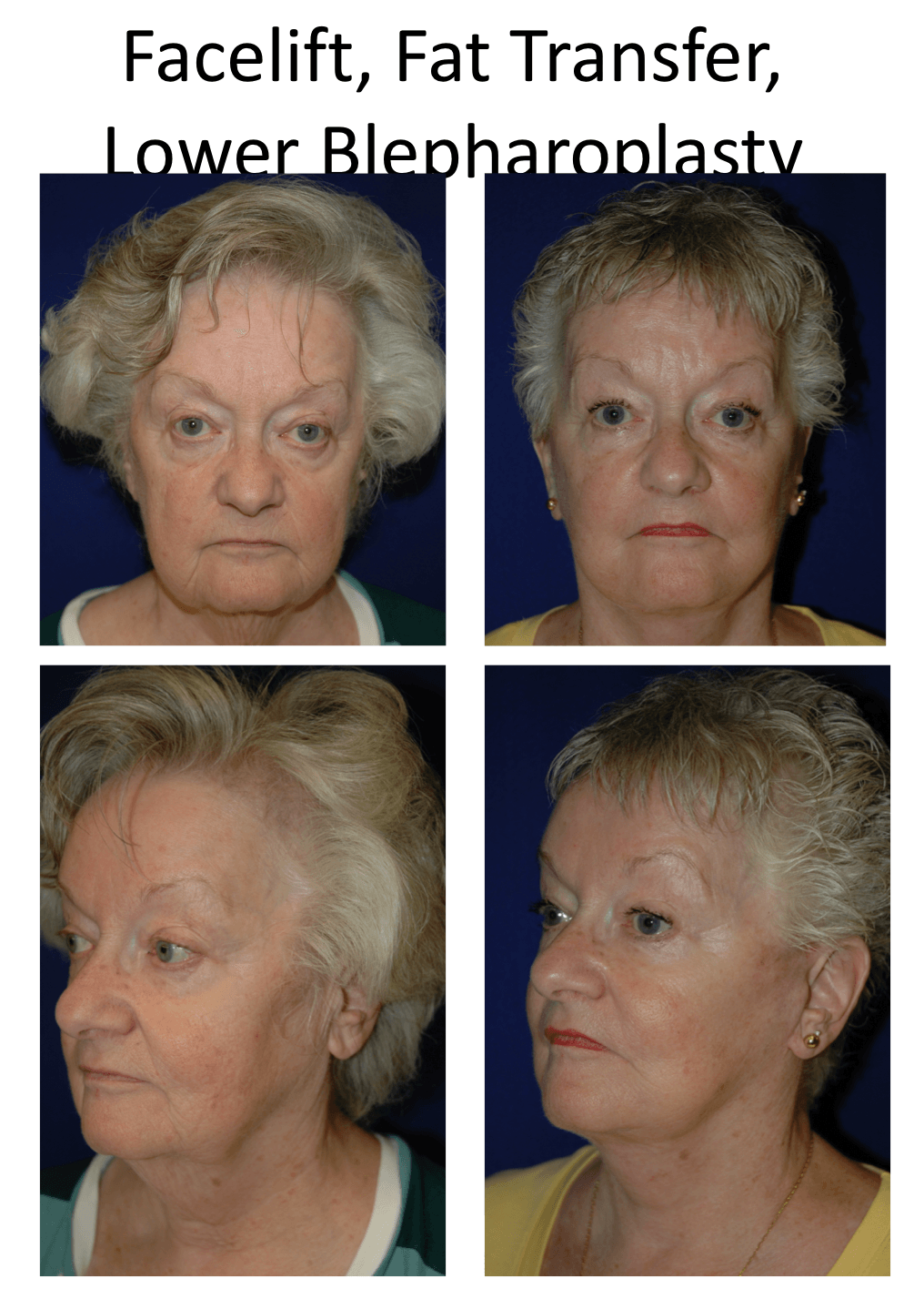 Facelift | Englewood, NJ | Dr. Kevin Ende, M.D.