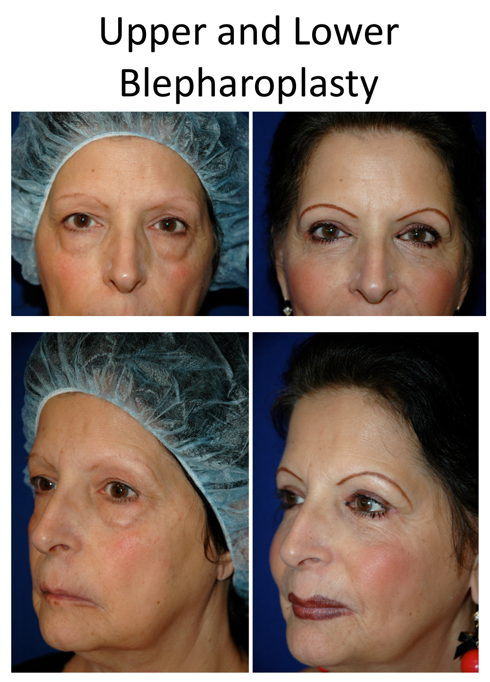 Facelift | Englewood, NJ | Dr. Kevin Ende, M.D.