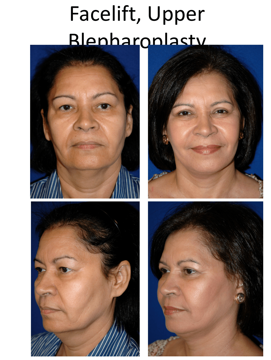 Facelift | Englewood, NJ | Dr. Kevin Ende, M.D.