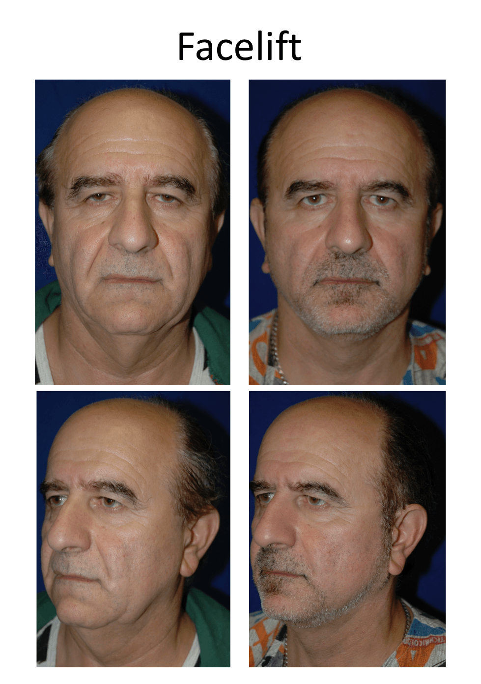 Facelift | Englewood, NJ | Dr. Kevin Ende, M.D.