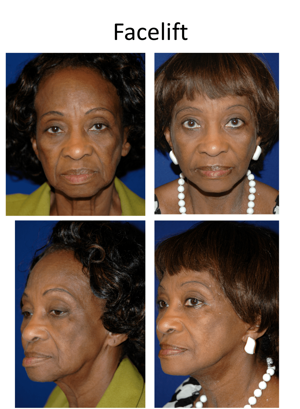 Facelift | Englewood, NJ | Dr. Kevin Ende, M.D.