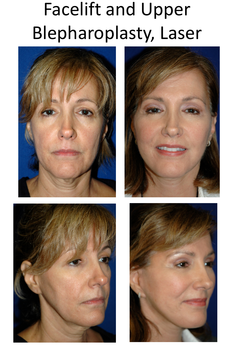 Facelift | Englewood, NJ | Dr. Kevin Ende, M.D.