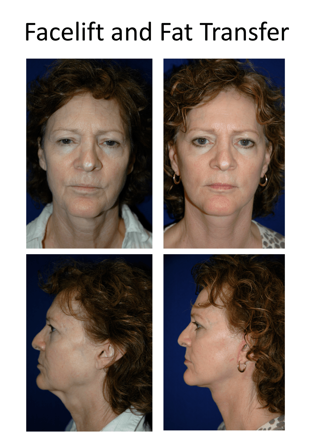 Facelift | Englewood, NJ | Dr. Kevin Ende, M.D.