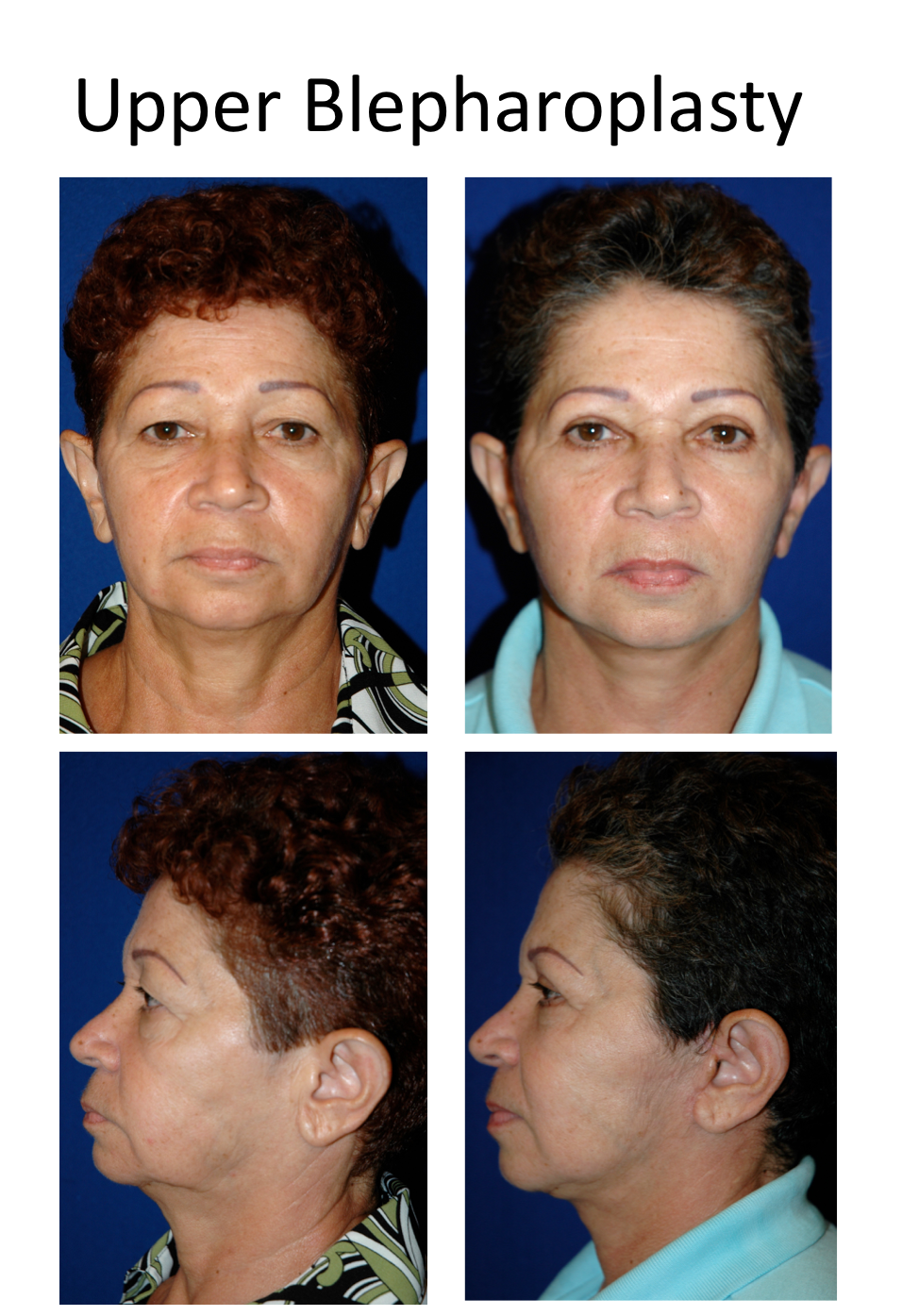Facelift | Englewood, NJ | Dr. Kevin Ende, M.D.