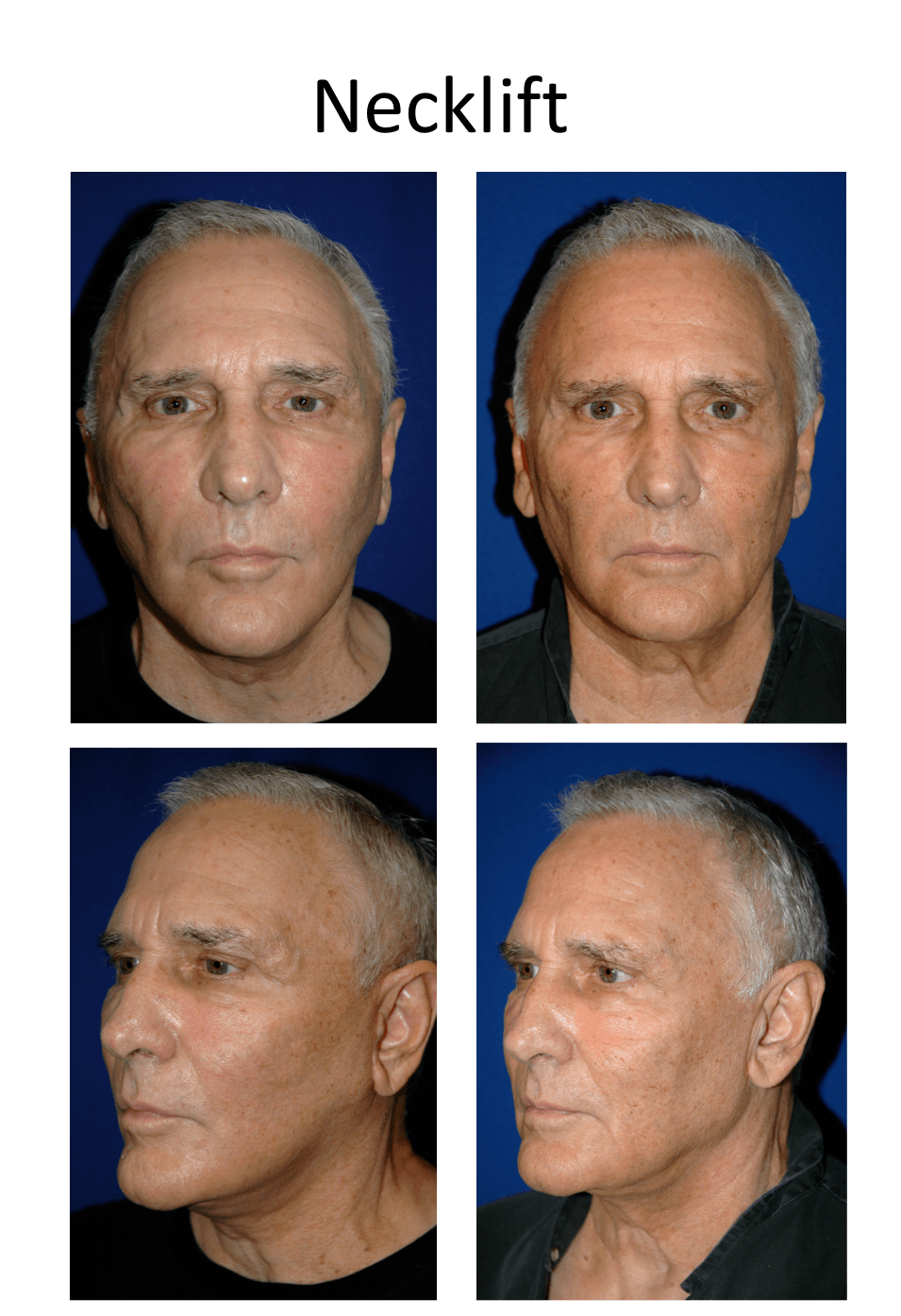 Facelift | Englewood, NJ | Dr. Kevin Ende, M.D.