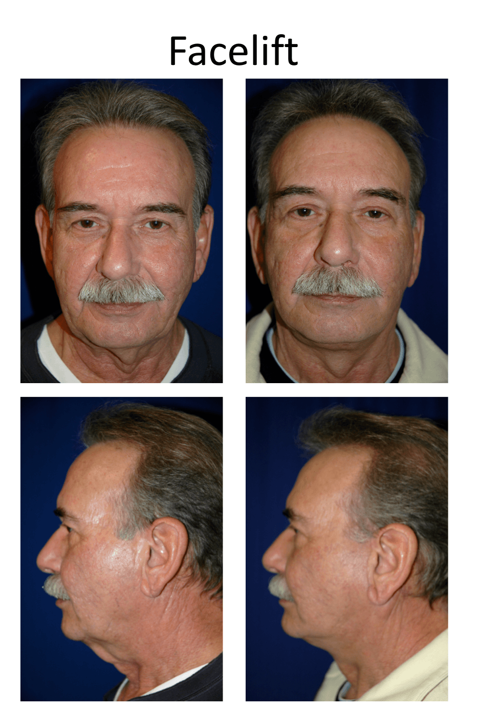 Facelift | Englewood, NJ | Dr. Kevin Ende, M.D.