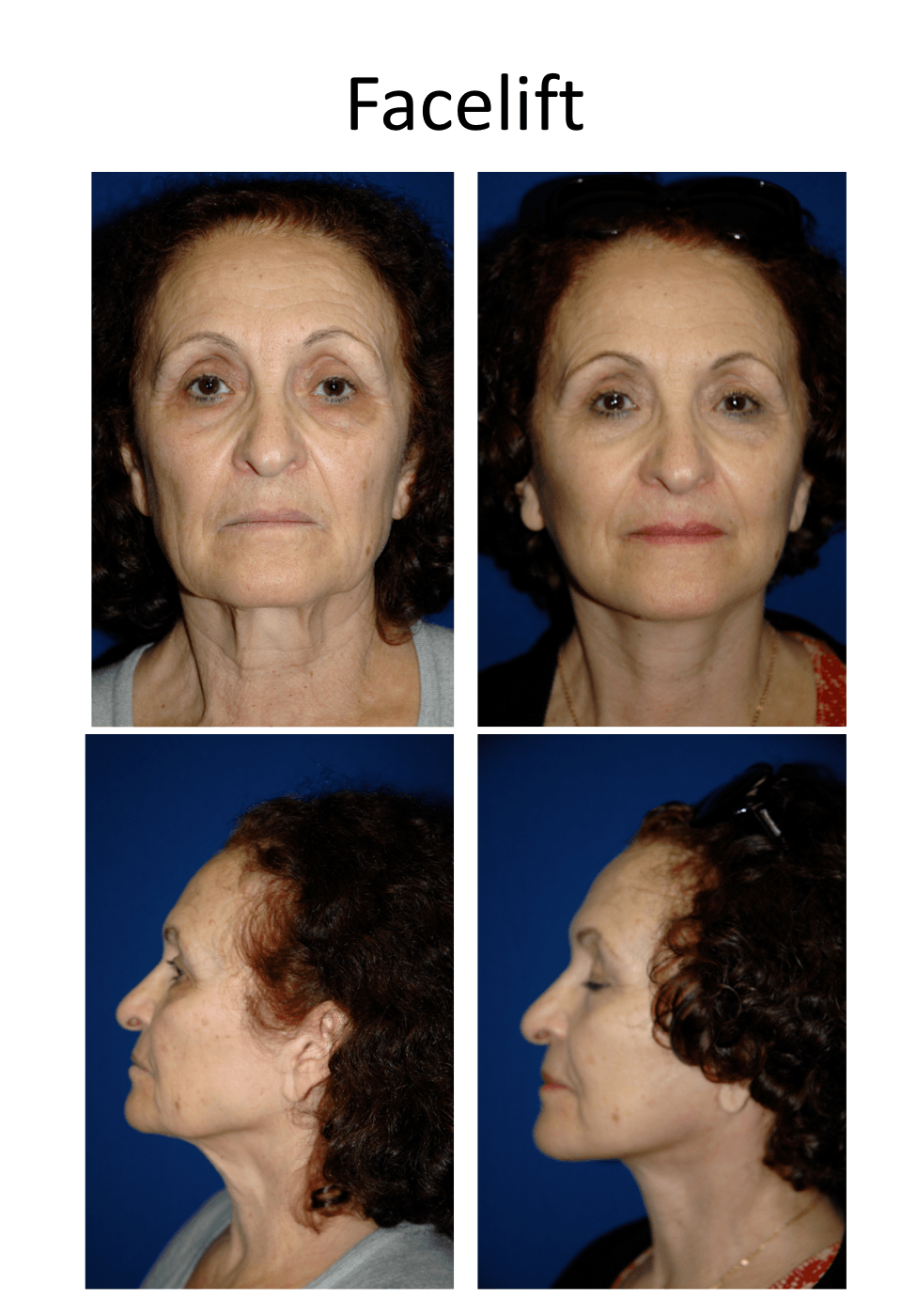 Facelift | Englewood, NJ | Dr. Kevin Ende, M.D.