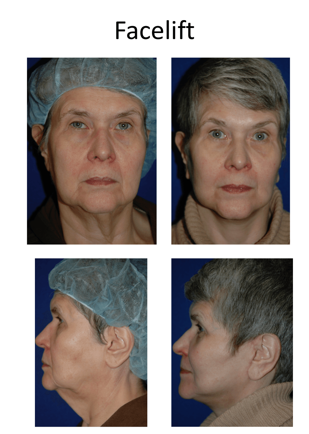 Facelift | Englewood, NJ | Dr. Kevin Ende, M.D.