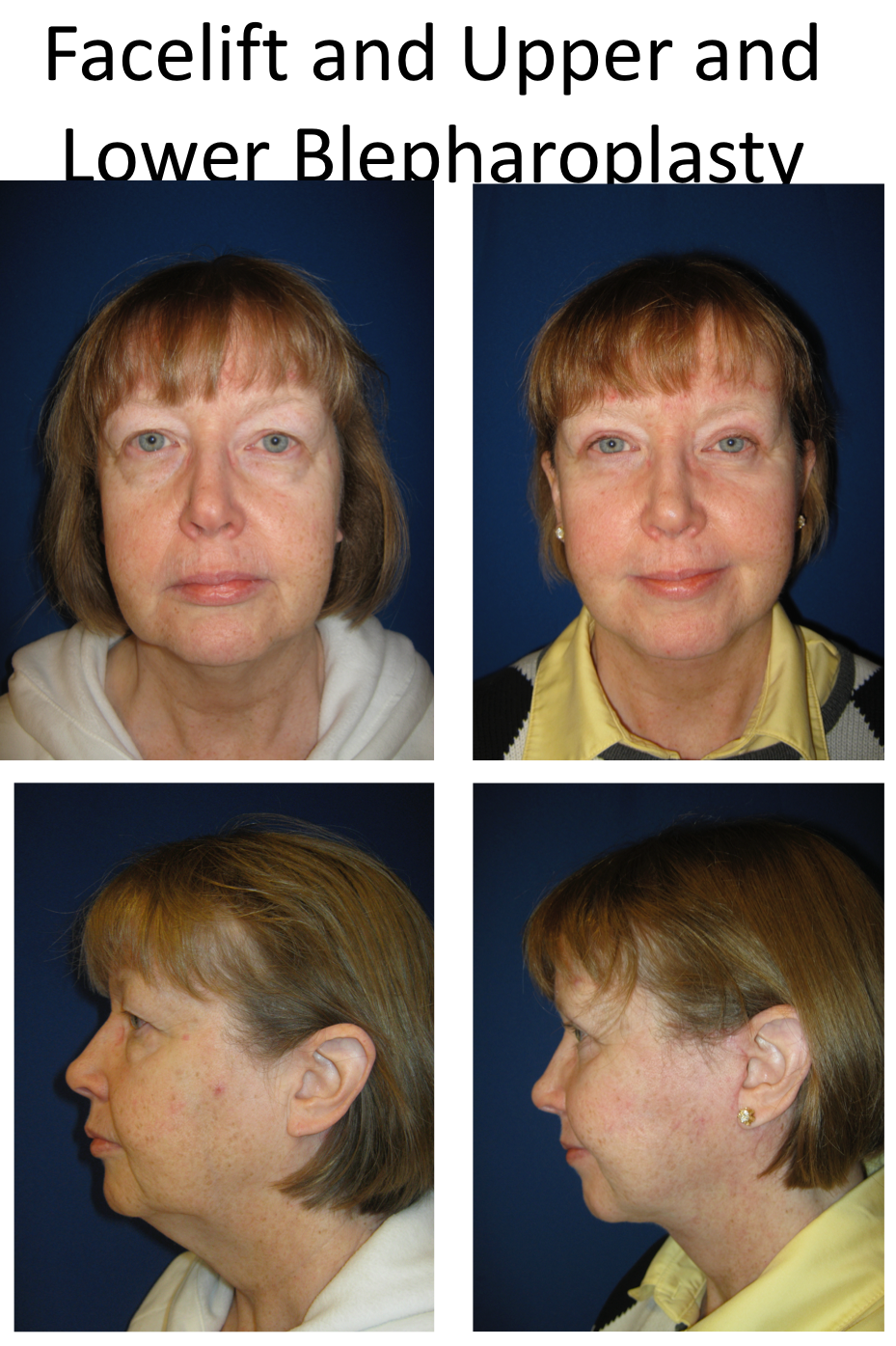 Facelift | Englewood, NJ | Dr. Kevin Ende, M.D.