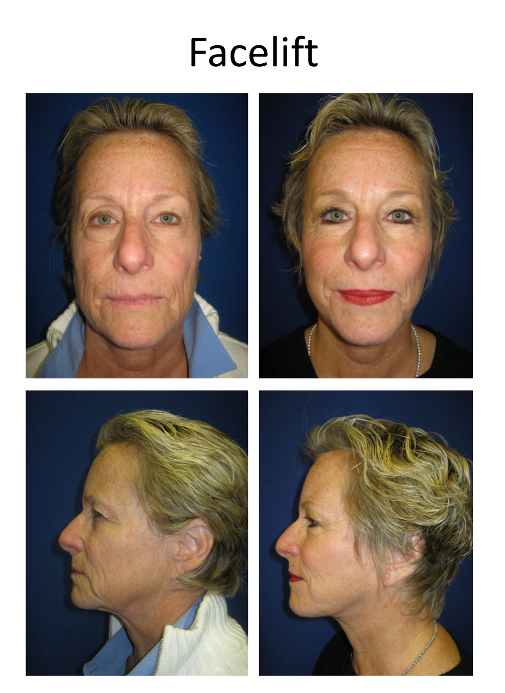 Facelift | Englewood, NJ | Dr. Kevin Ende, M.D.