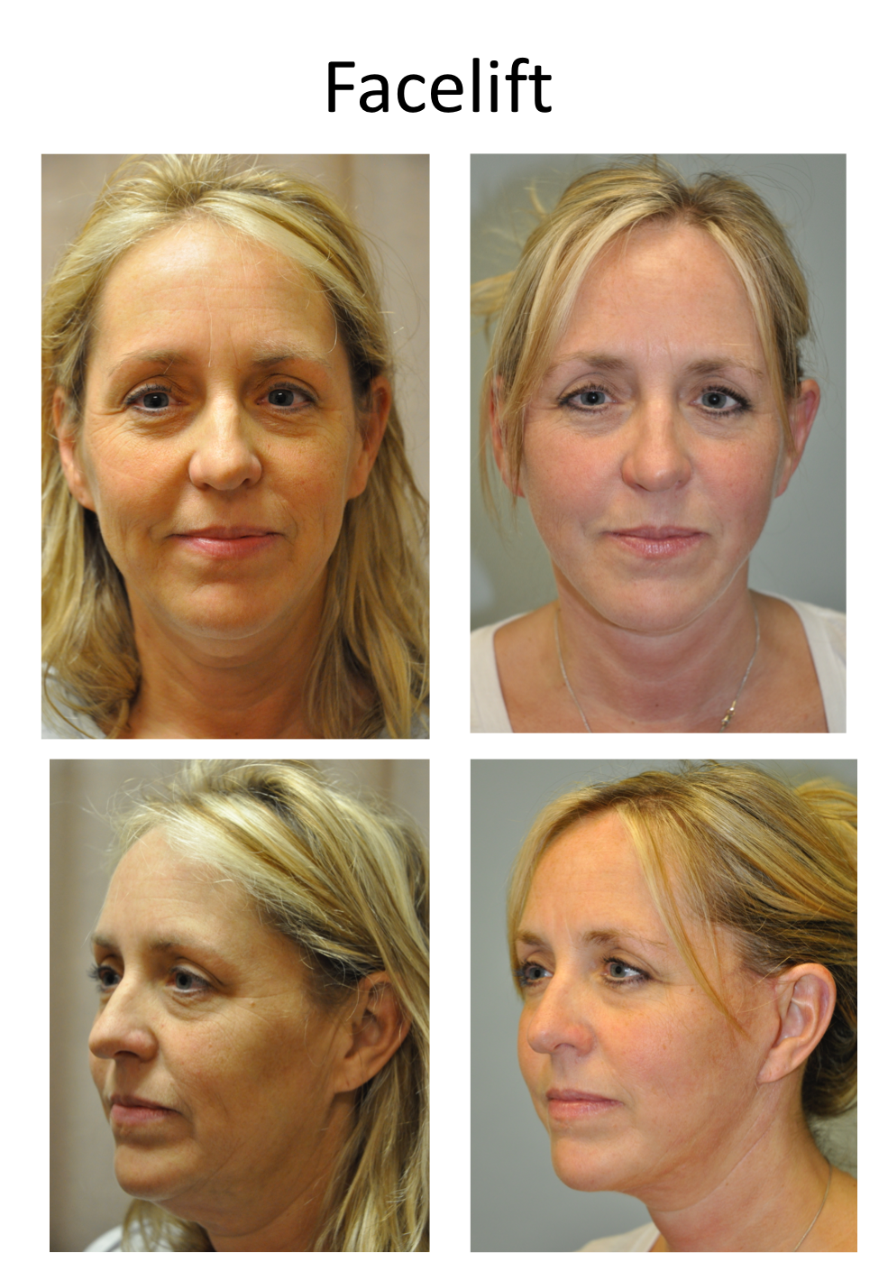 Facelift | Englewood, NJ | Dr. Kevin Ende, M.D.