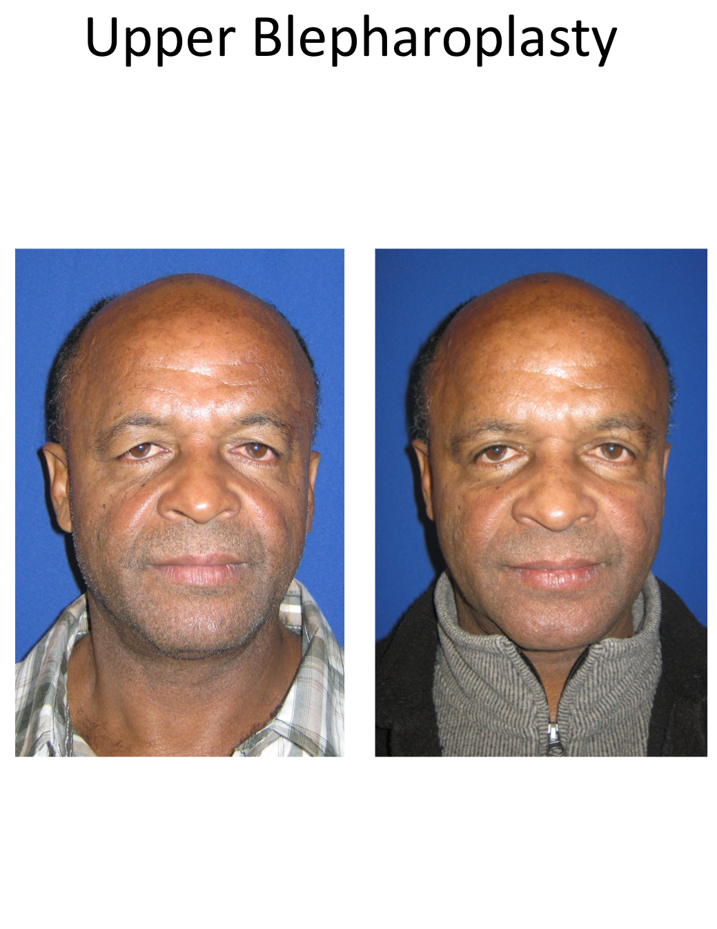 Facelift | Englewood, NJ | Dr. Kevin Ende, M.D.