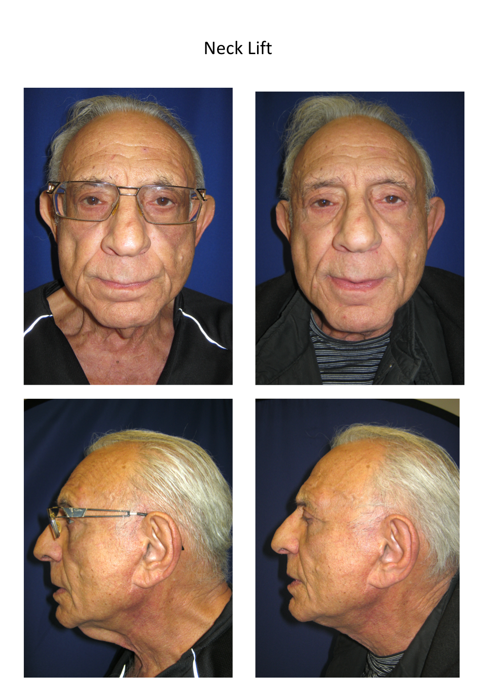 Facelift | Englewood, NJ | Dr. Kevin Ende, M.D.