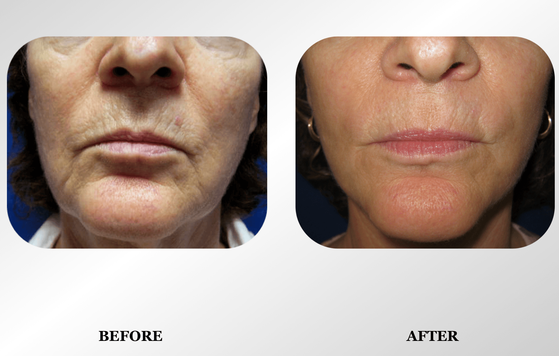 Facelift | Englewood, NJ | Dr. Kevin Ende, M.D.