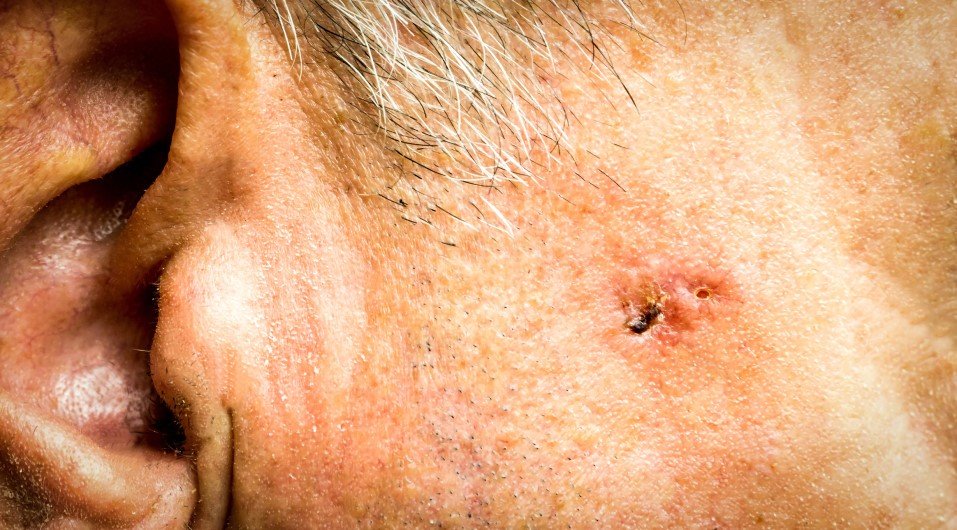 Facial Skin Cancer | Cosmetic Surgeon | Toowoomba